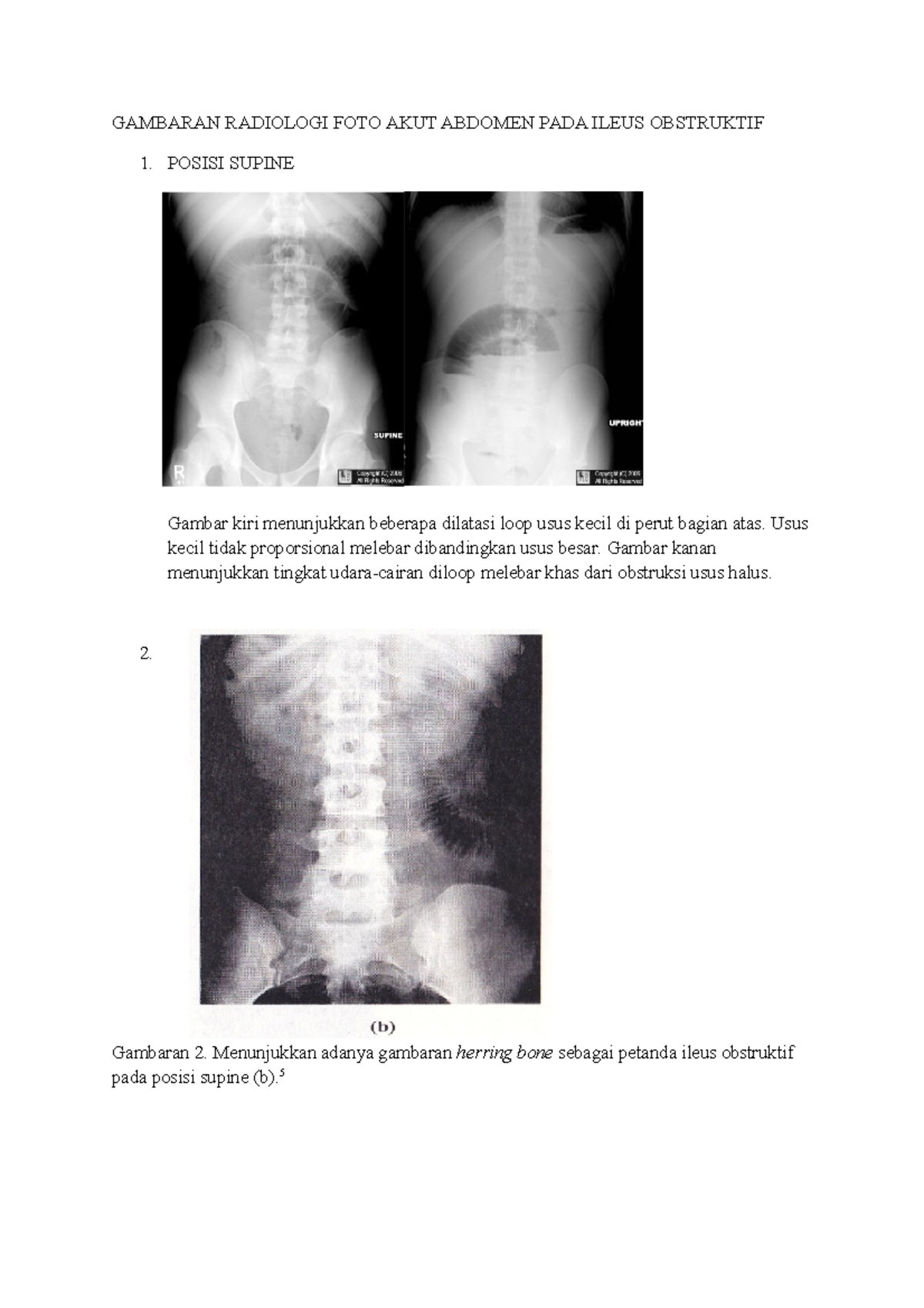 Gambaran Radiologi Akut Abdomen pada Ileus Obstruktif dan Paralitik ...