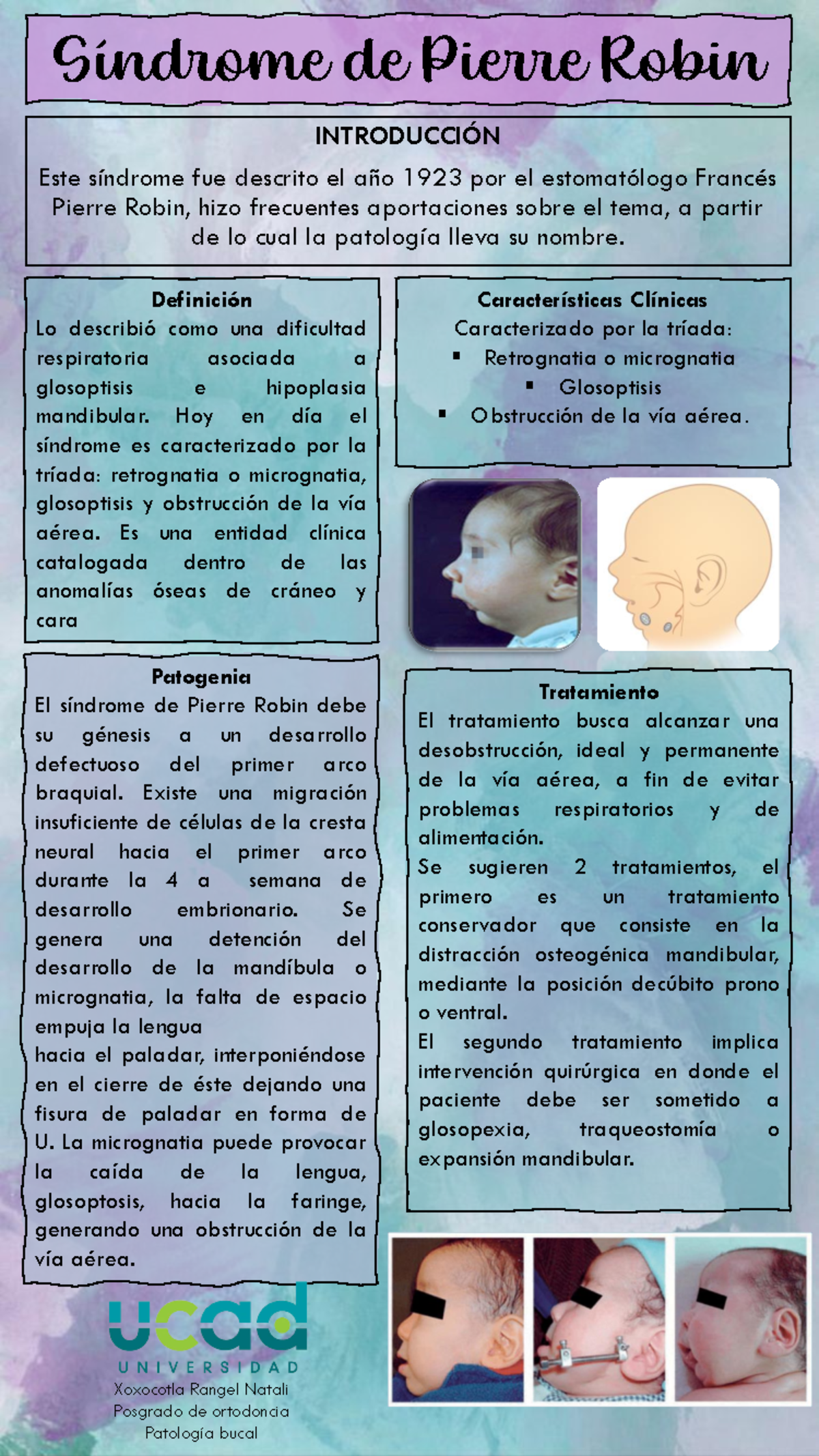 Síndrome de Pierre Robin: Clasificación y Tratamiento en Ortodoncia ...