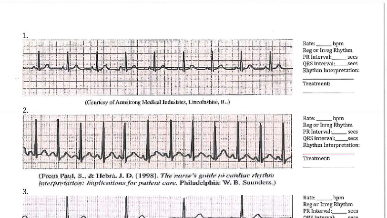EKG Rhythm Strips Pretest: Interpretation & Treatment Guide - Studocu