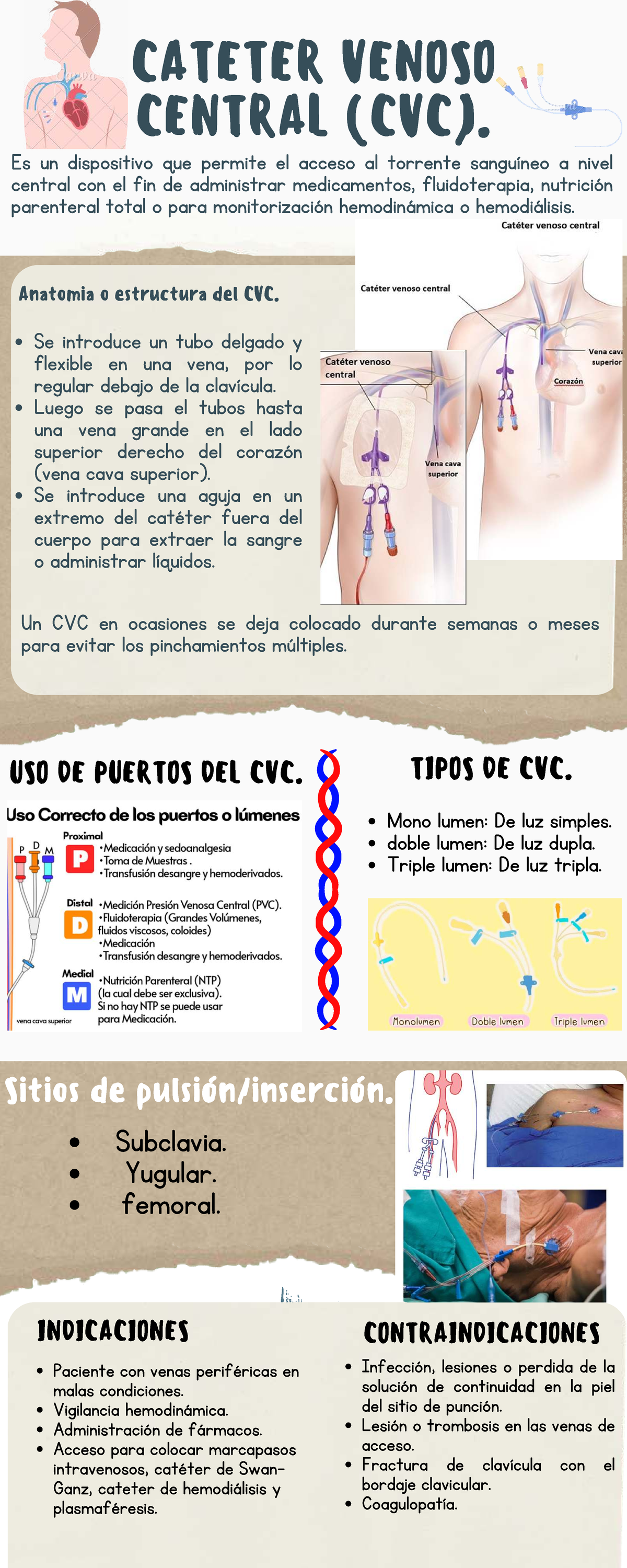 Infografía sobre Catéter Venoso Central (CVC) y su Uso - Studocu