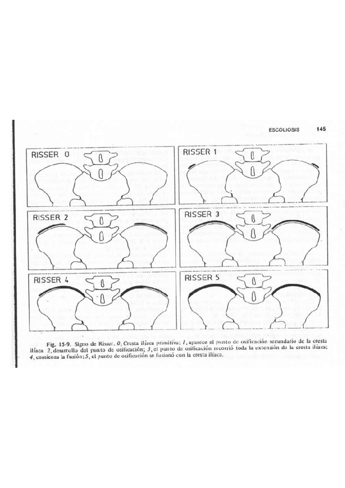 ESCOLIOSIS 145: Signo de Risser y Desarrollo de la Cresta Iliaca - Studocu