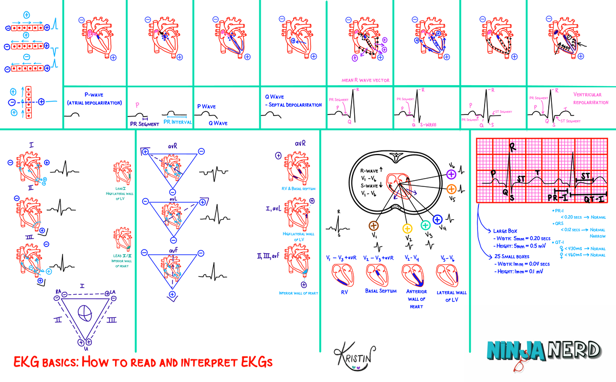 EKG Basics (new) image - Hithere - 1 MEAN R WAVE VECTOR R R R Q WAVE ...