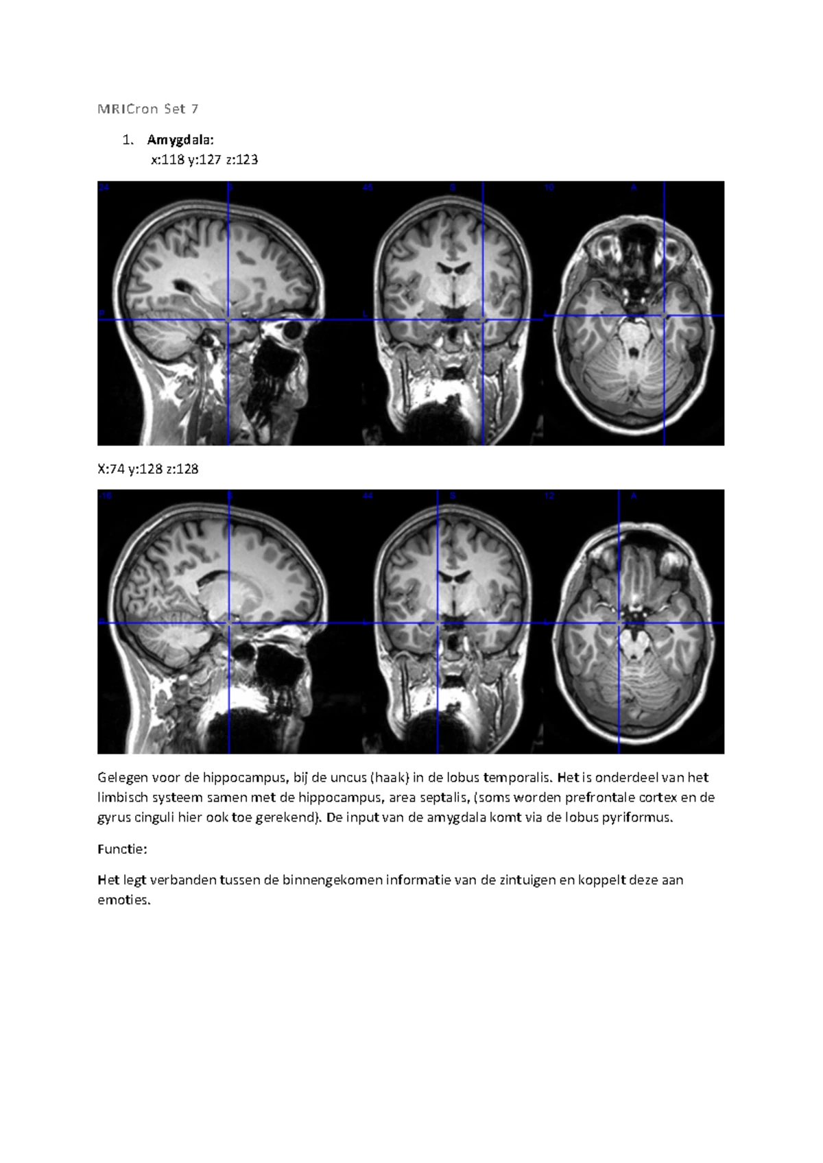 Peritoneum - Peritoneum intraperitoneaal retroperitoneaal (primair en ...