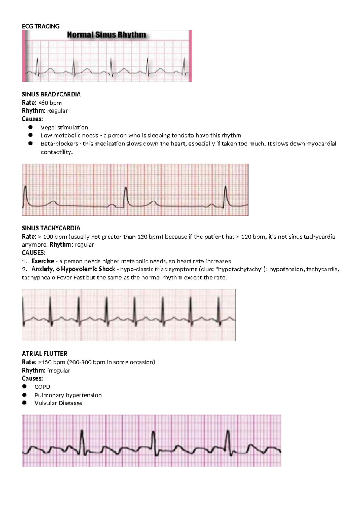 ECG Tracing: Sinus Bradycardia, Tachycardia & Atrial Flutter - Studocu