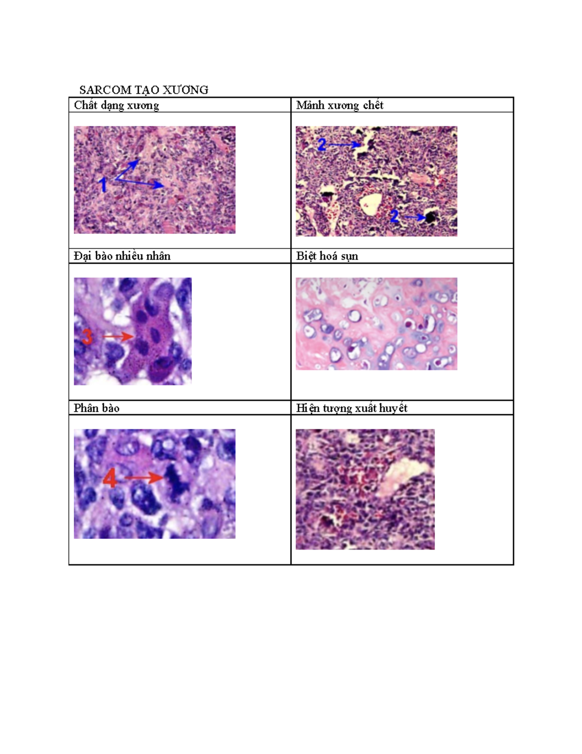 Ttgpb B4+5 - Ghi chú về Sarcom và Carcinom trong Tế bào học - Studocu