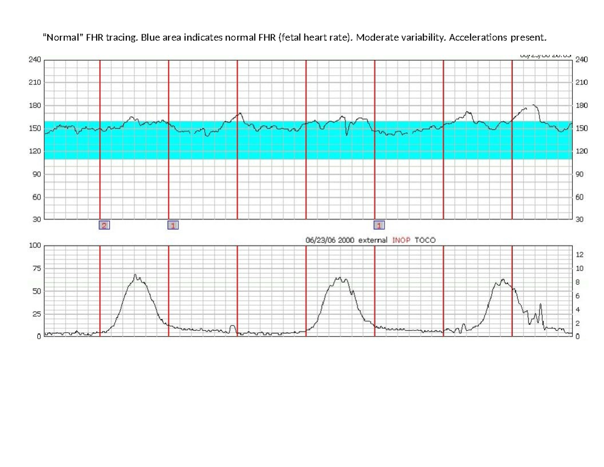 FHR Strips 1 Handout - Nurs 306 - “Normal” FHR tracing. Blue area ...