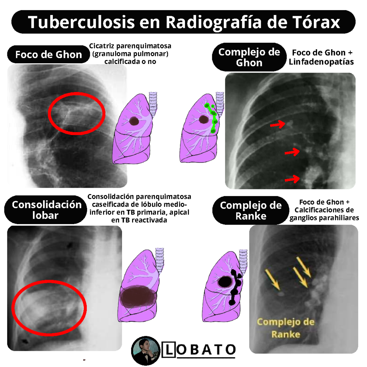 Signos Radiográficos de Tuberculosis: Foco de Ghon y Más - Studocu