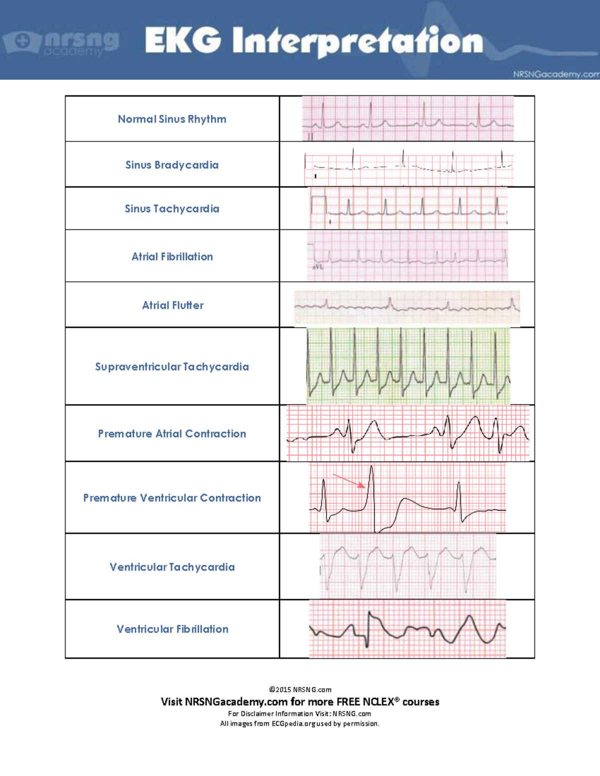 10 Common EKG Heart Rhythms - ADN-171 - ©2015 NRSNG Visit NRSNGacademy ...