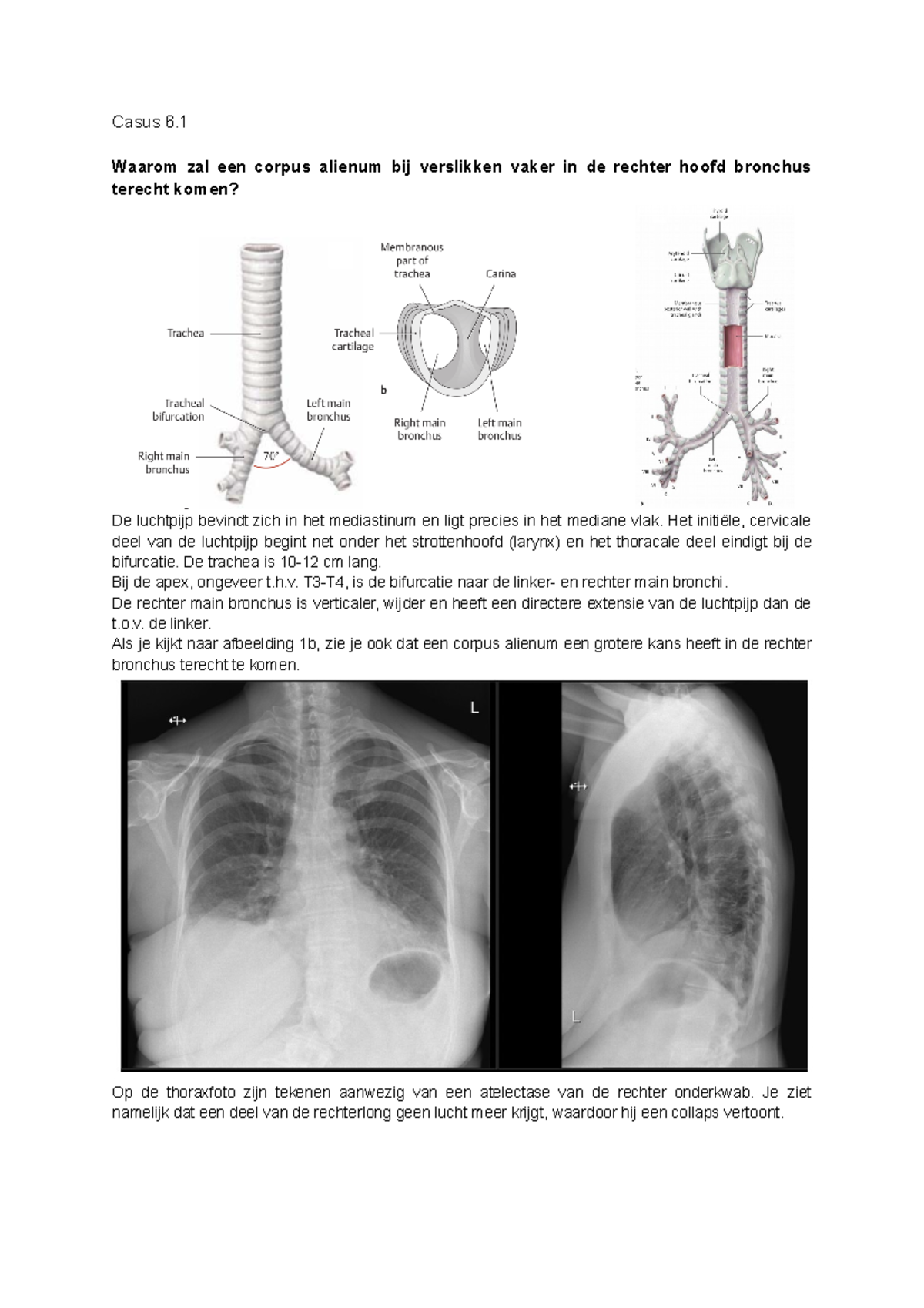 Casus 6.1: Atelectase en Corpus Alienum in de Rechter Bronchus ...