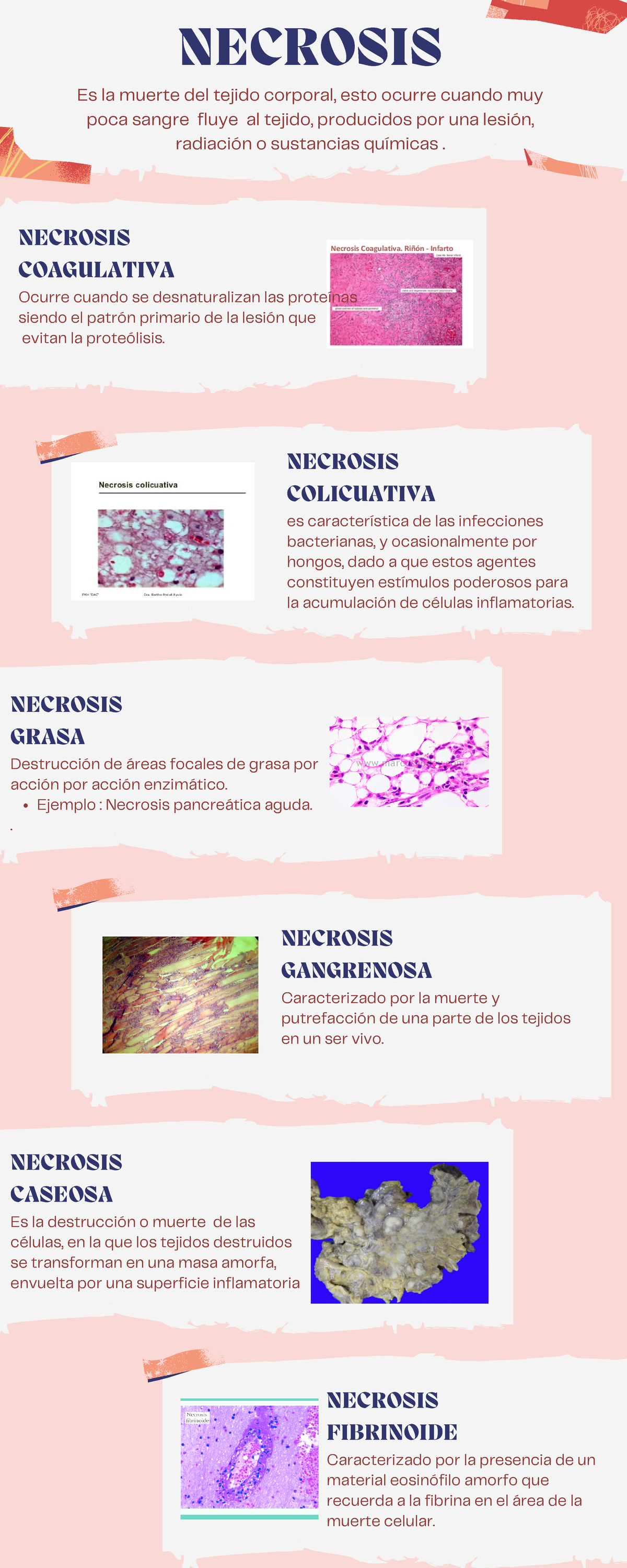 Infografía sobre la Necrosis: Tipos, Causas y Ejemplos - Studocu