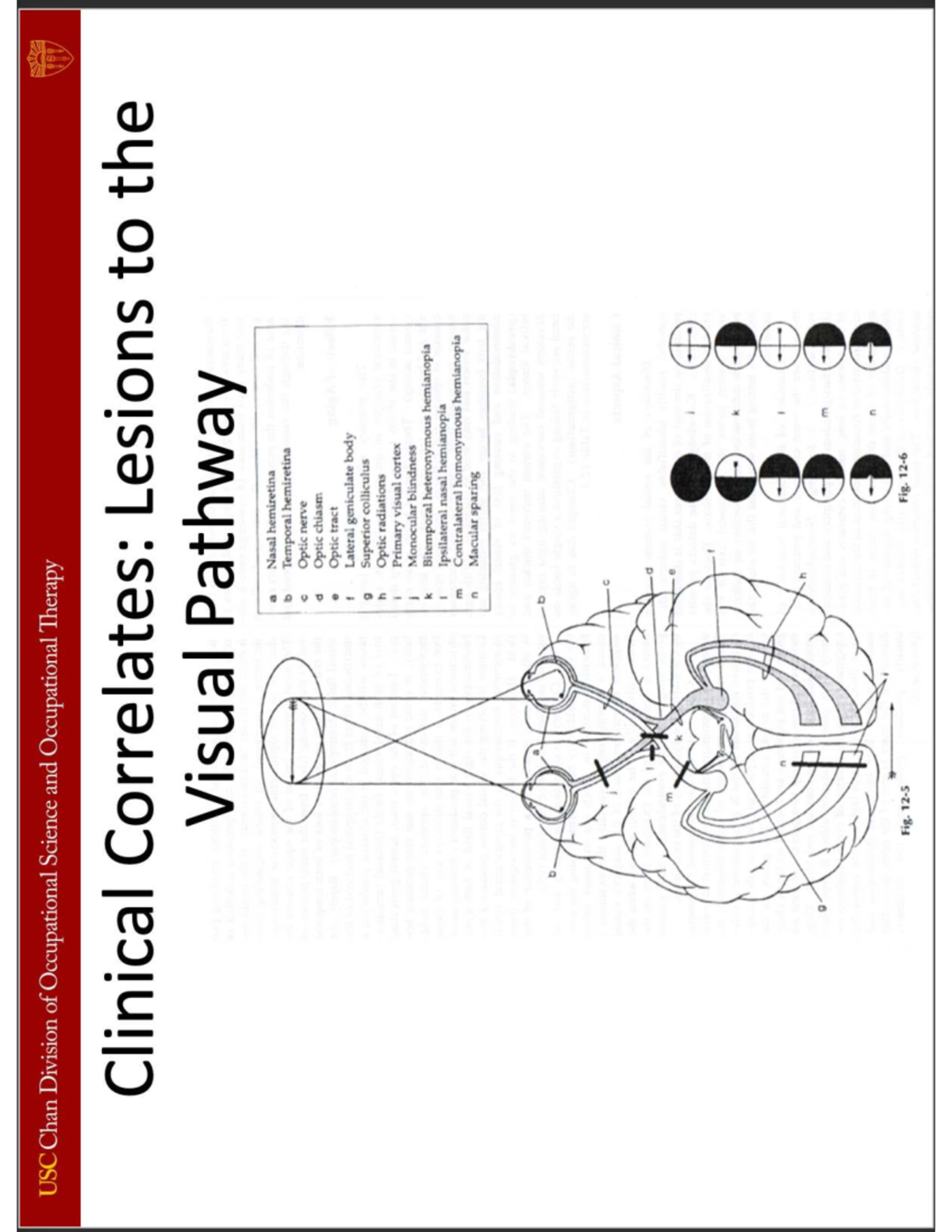 USC OT Clinical Correlates: Visual Pathway Lesions Analysis - Studocu