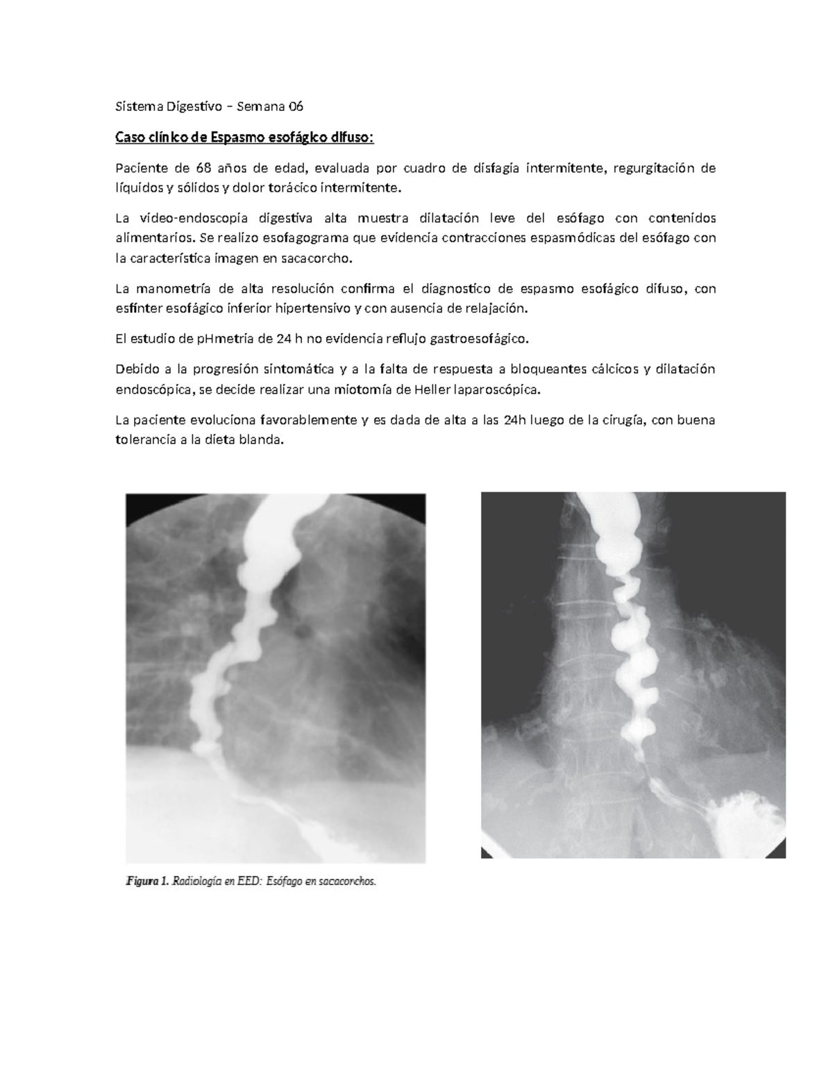 Caso Clínico: Espasmo Esofágico Difuso - Sistema Digestivo Semana 06 ...