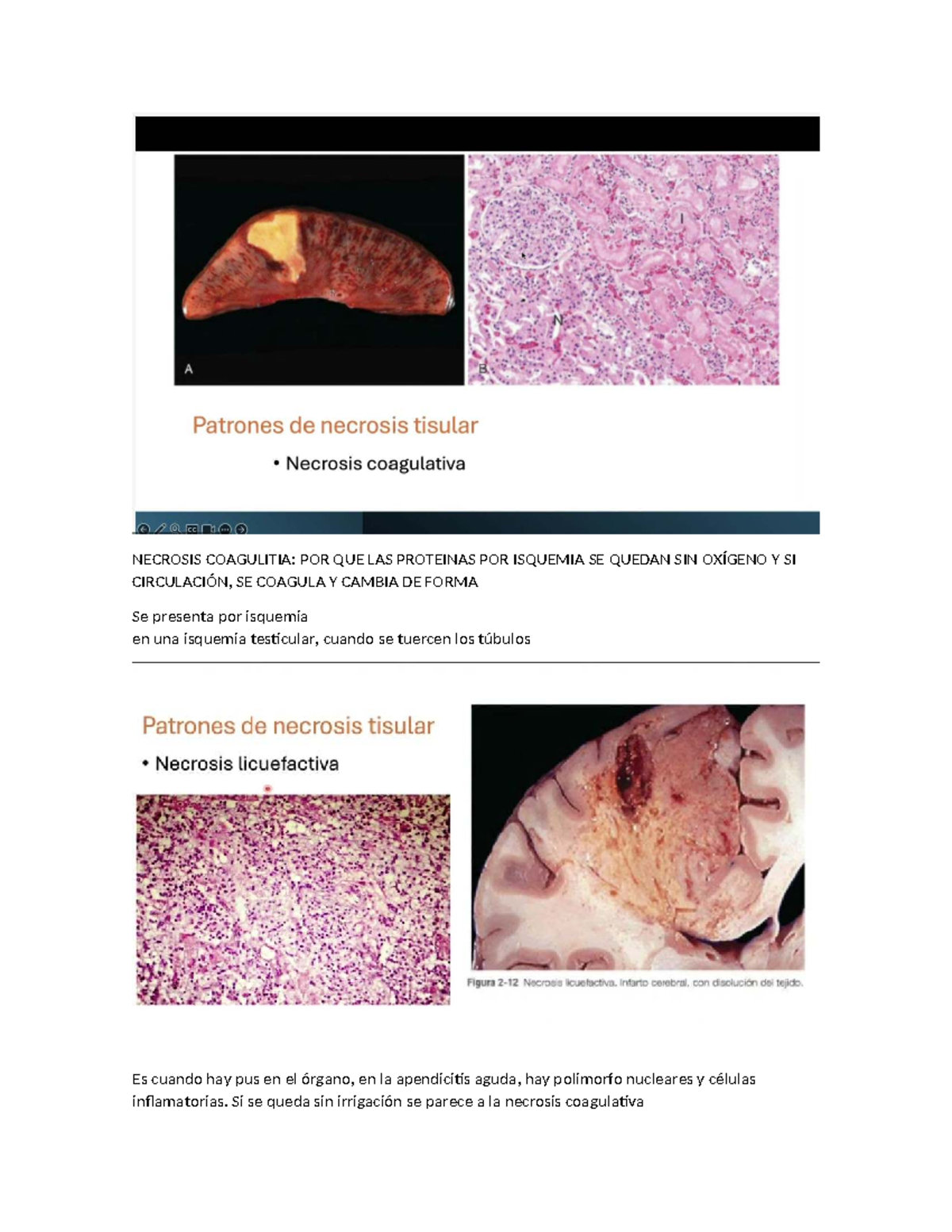 Necrosis Coagulativa: Mecanismos y Efectos en Isquemia (Cap 2) - Studocu