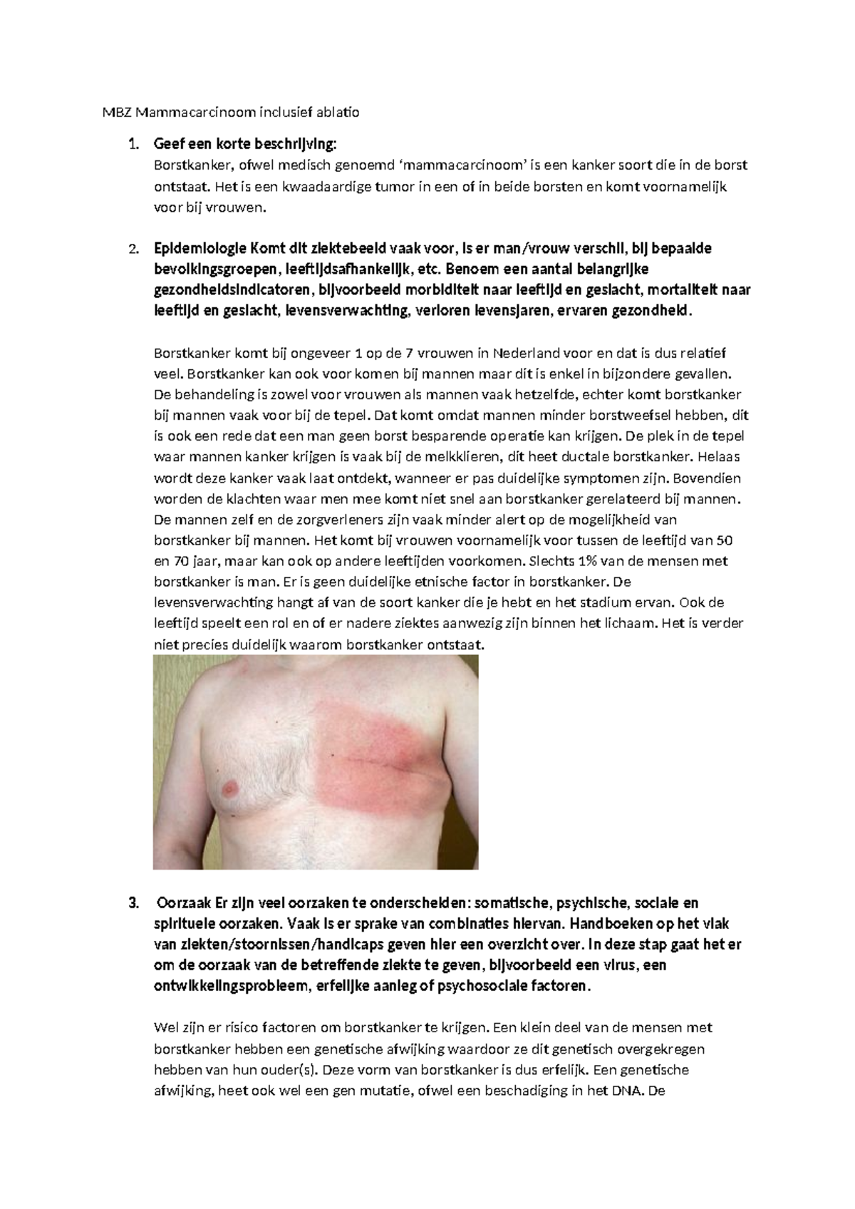 MBZ Mammacarcinoom Inclusief Ablatio: Epidemiologie en Behandeling ...