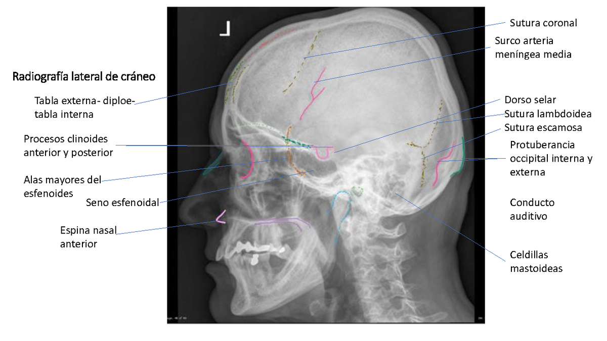 3 - anatomia radiologica rx craneo lateral - anatomía radiológica ...