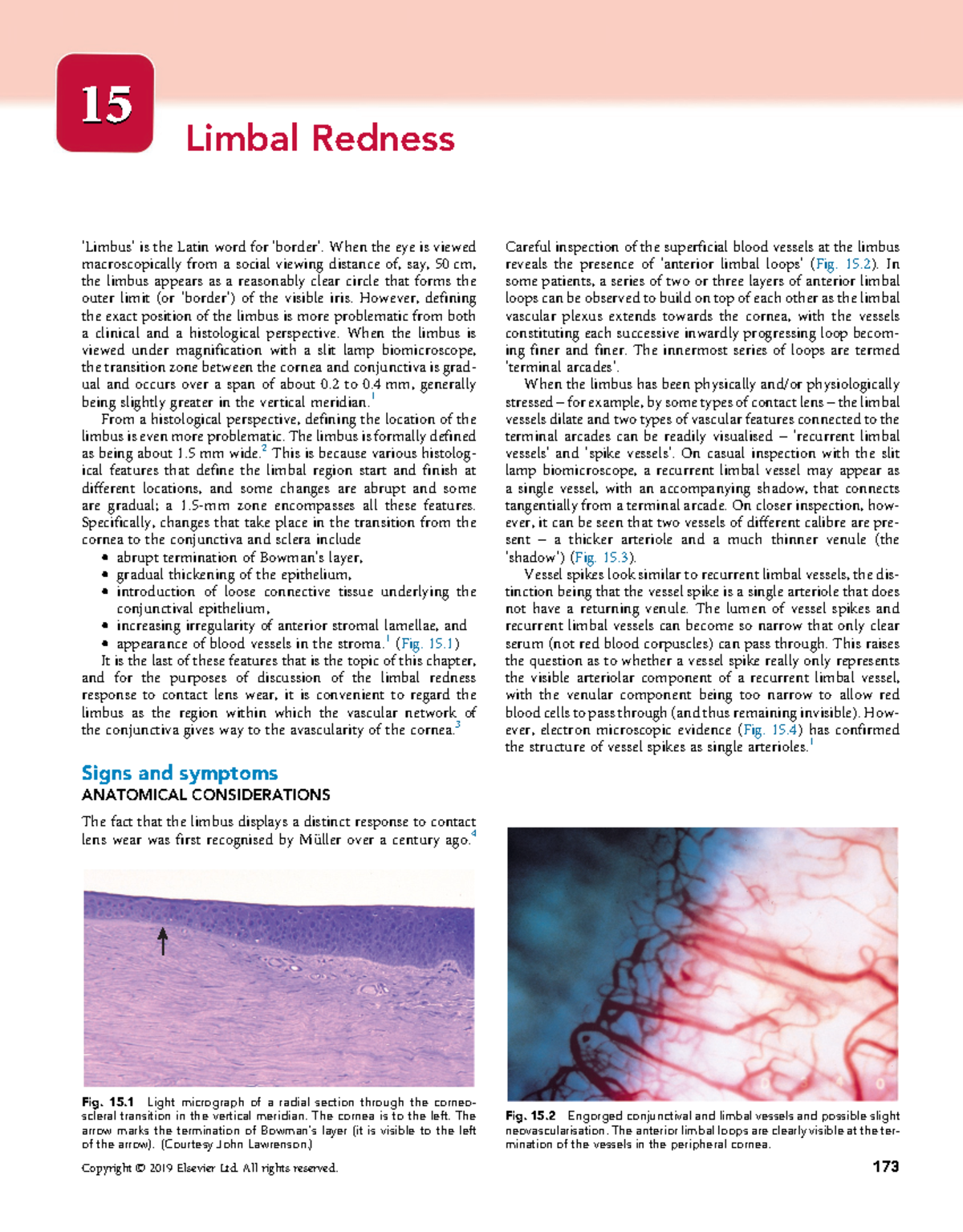 Limbal Redness Contact Lens Complications - 1515 Limbal Redness ‘Limbus ...