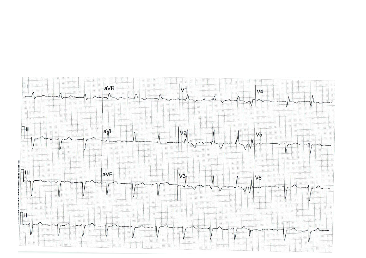 Atrial flutter with variable ventricular conduction - aVR V1 V4 aVL V2 ...
