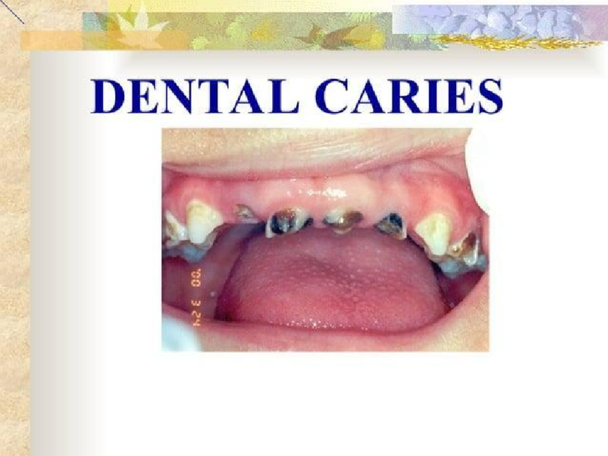DENTAL CARIES 628: Etiology, Diagnosis, Prevention & Treatment - Studocu