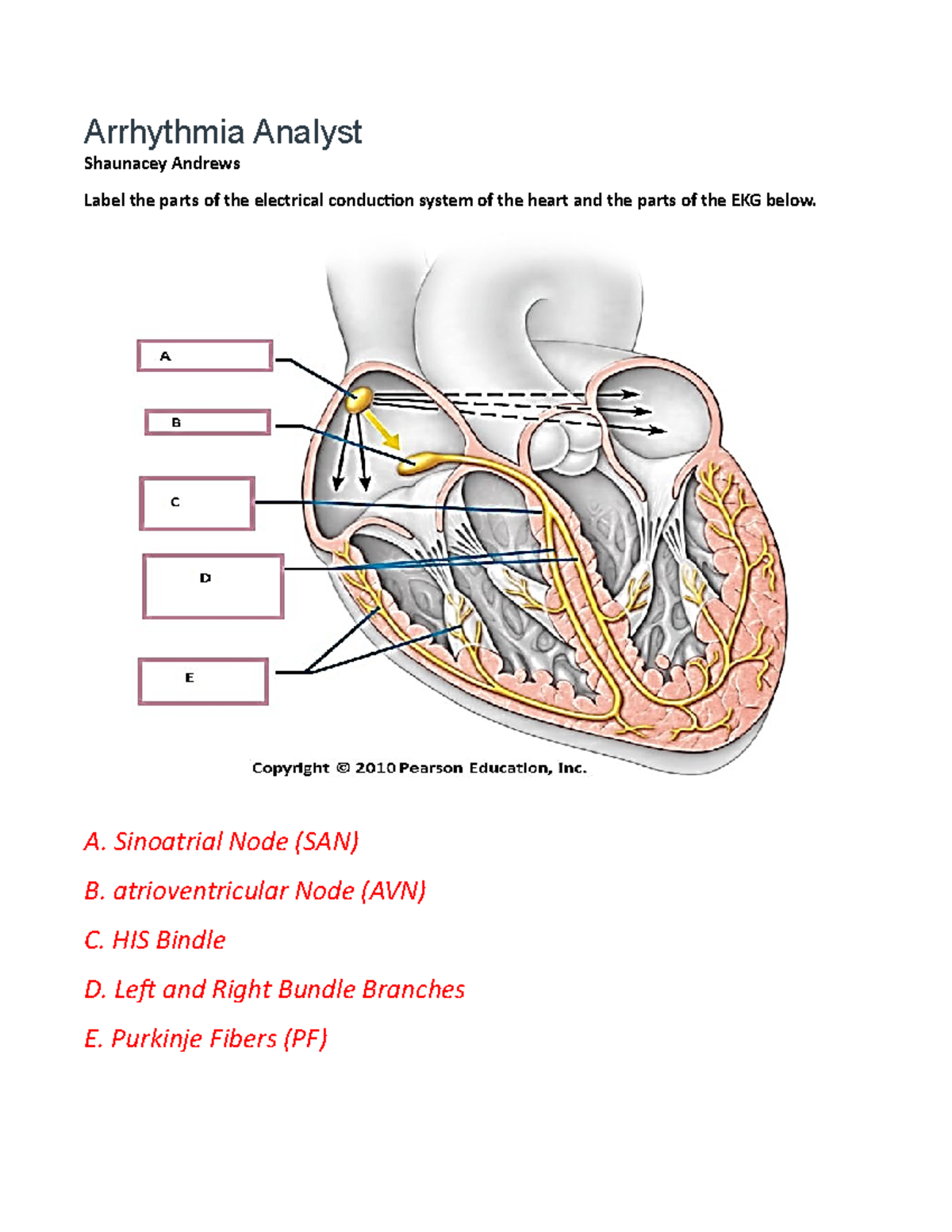 Arrhythmias Assignment - Electrical Conduction & EKG Analysis - Studocu