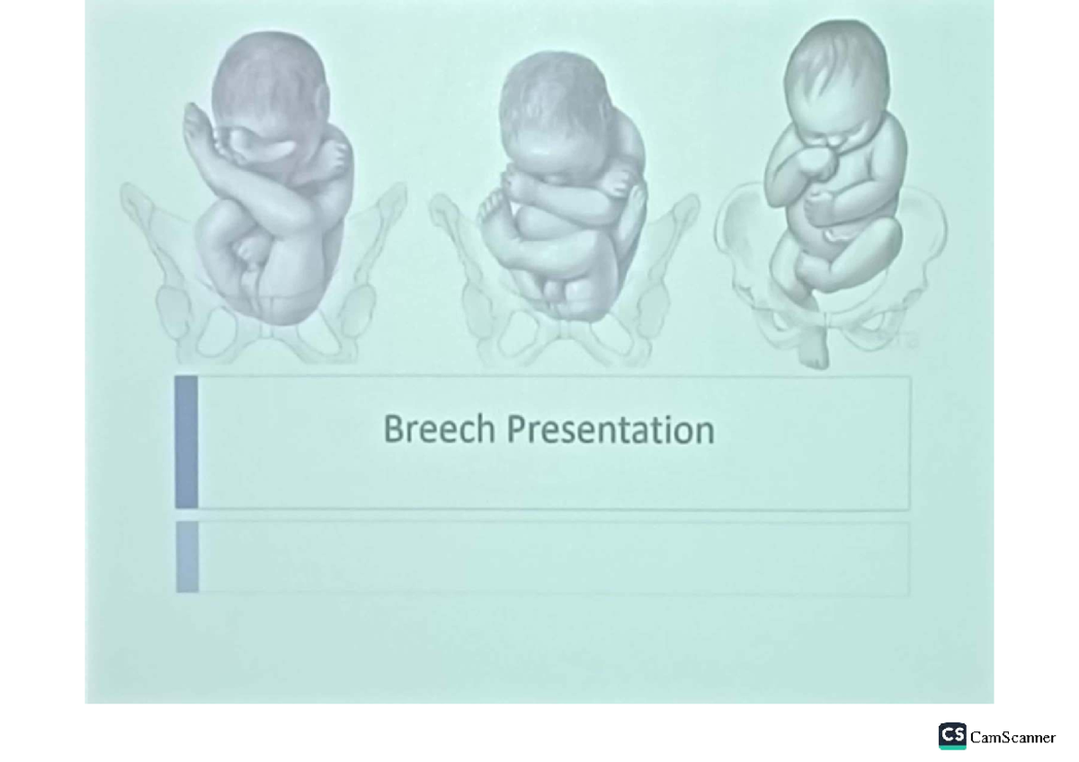 Breech Presentation CS: Classification, Diagnosis, and Delivery Methods ...