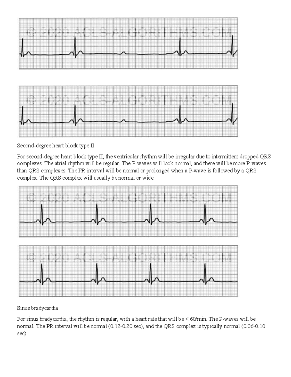 Rhythm strip practice - Study - Second-degree heart block type II. For ...