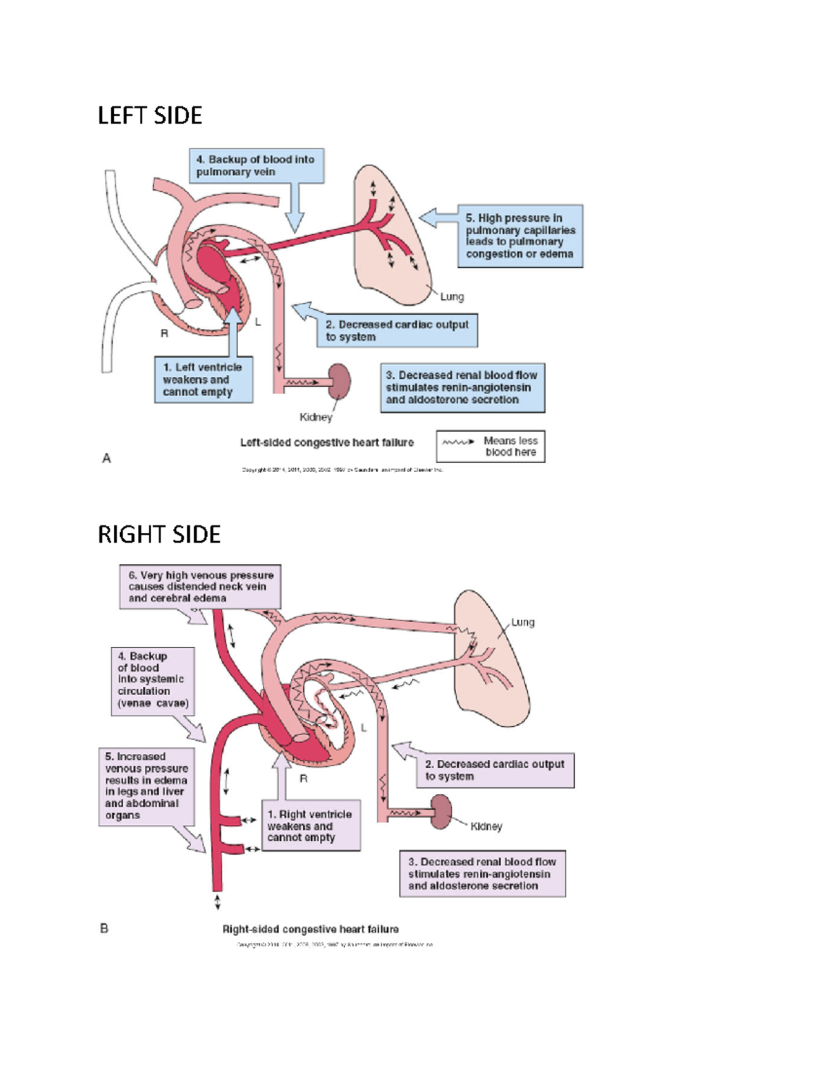 Understanding Congestive Heart Failure: Left & Right Side Diagrams ...