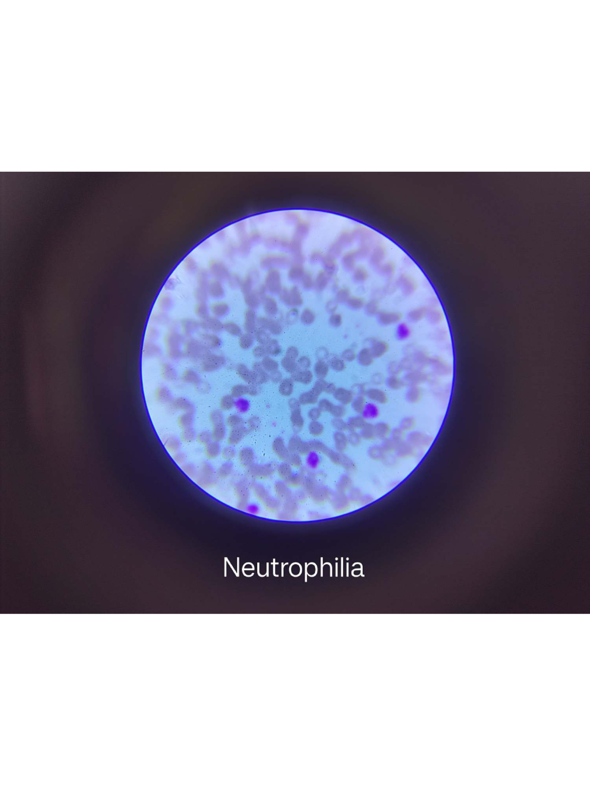 Pathology histology - Prof 2 final sample - Neutrophilia cosinopnhilia ...