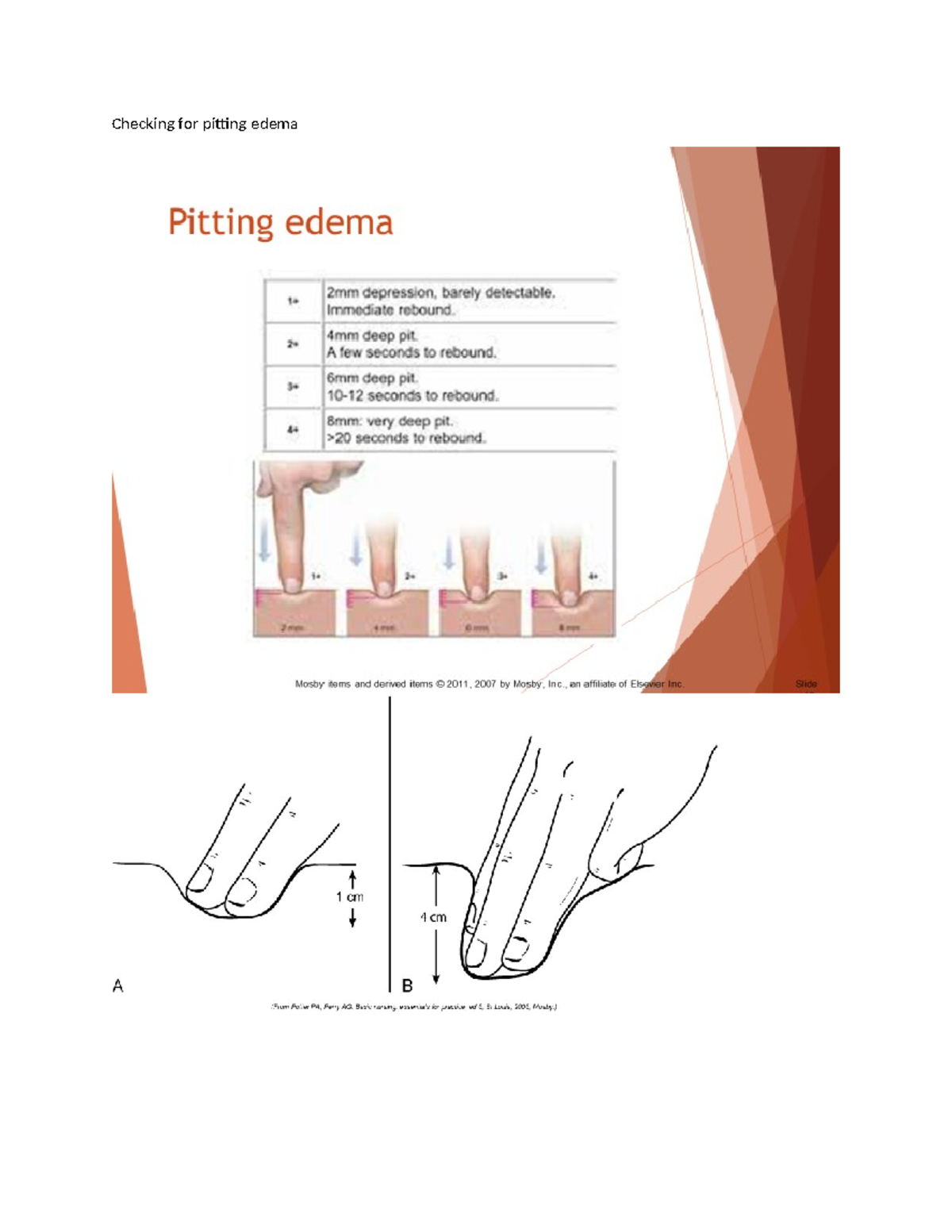 Pitting Edema Assessment Notes - Nursing 101 - Studocu