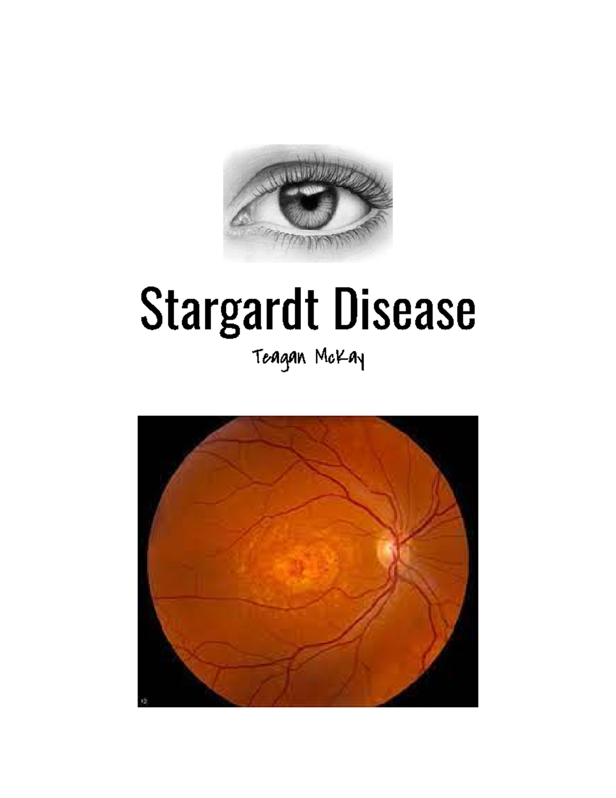 Stargardt Disease: Overview, Symptoms, and Genetic Insights - Studocu