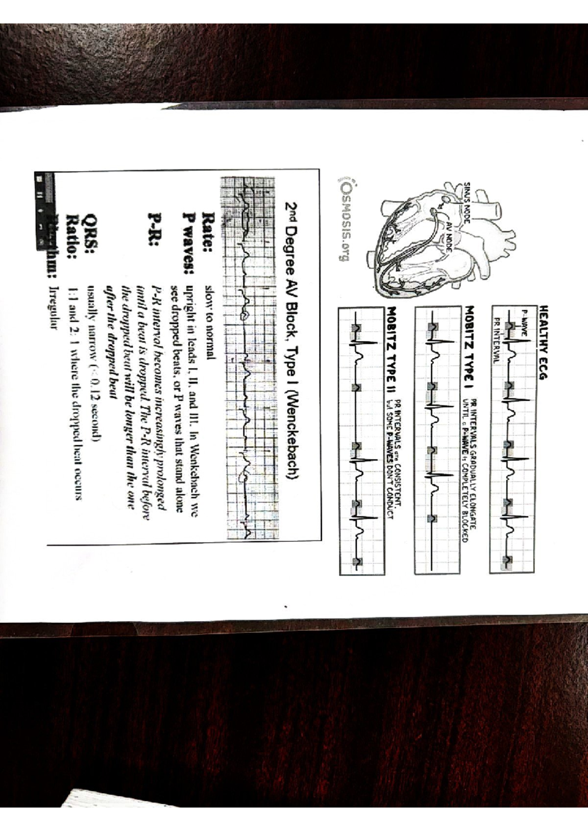 ECG Analysis: Mobitz Type I & Heart Block Patterns (HEALTHY ECG) - Studocu