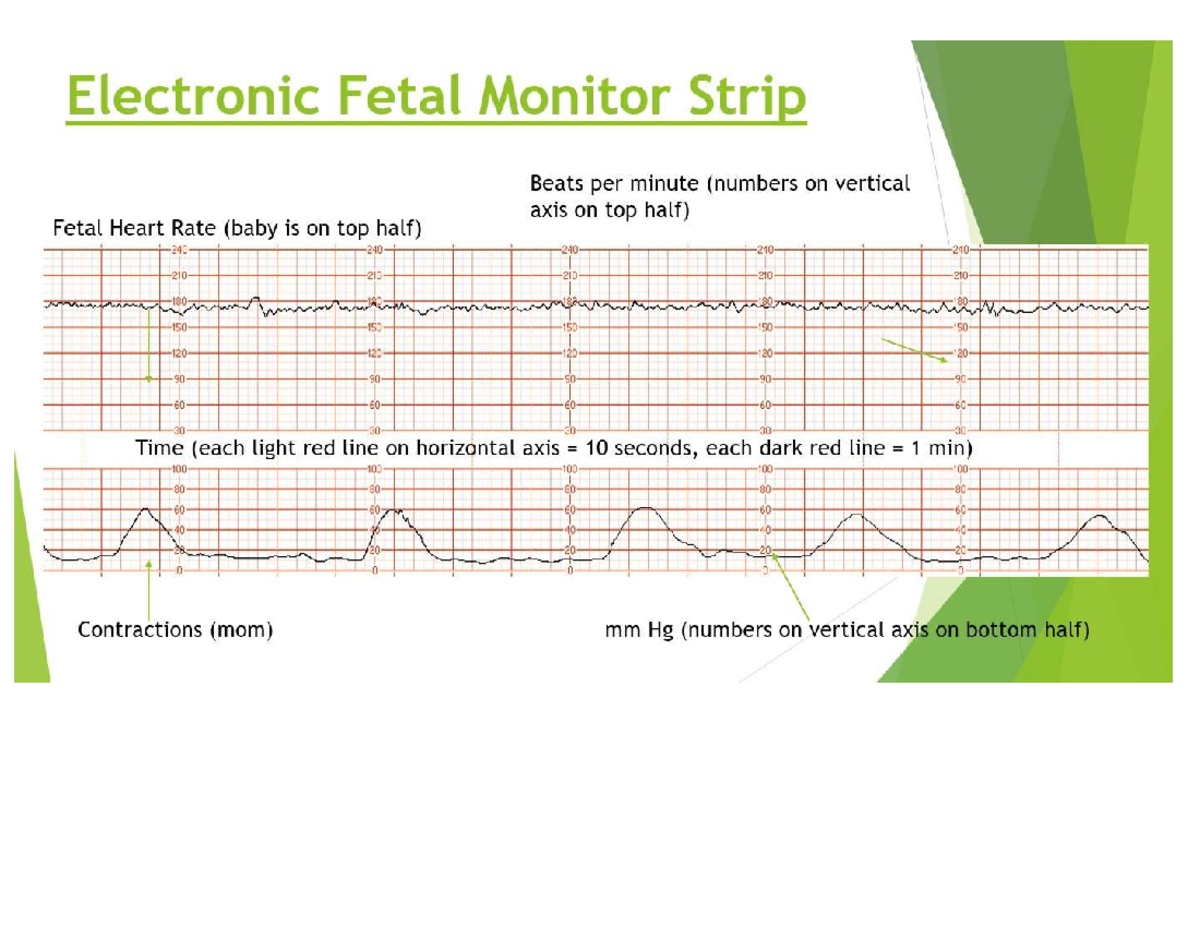 Fetal Heart Rate Patterns: VEAL CHOP Tracings Analysis - Studocu