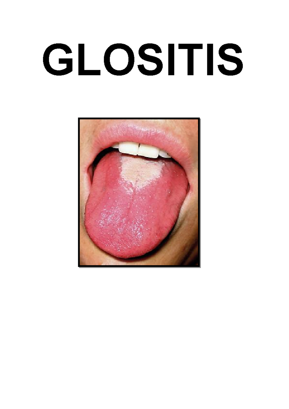 Glositis - GLOSITIS GLOSITIS GLOSITIS - Studocu