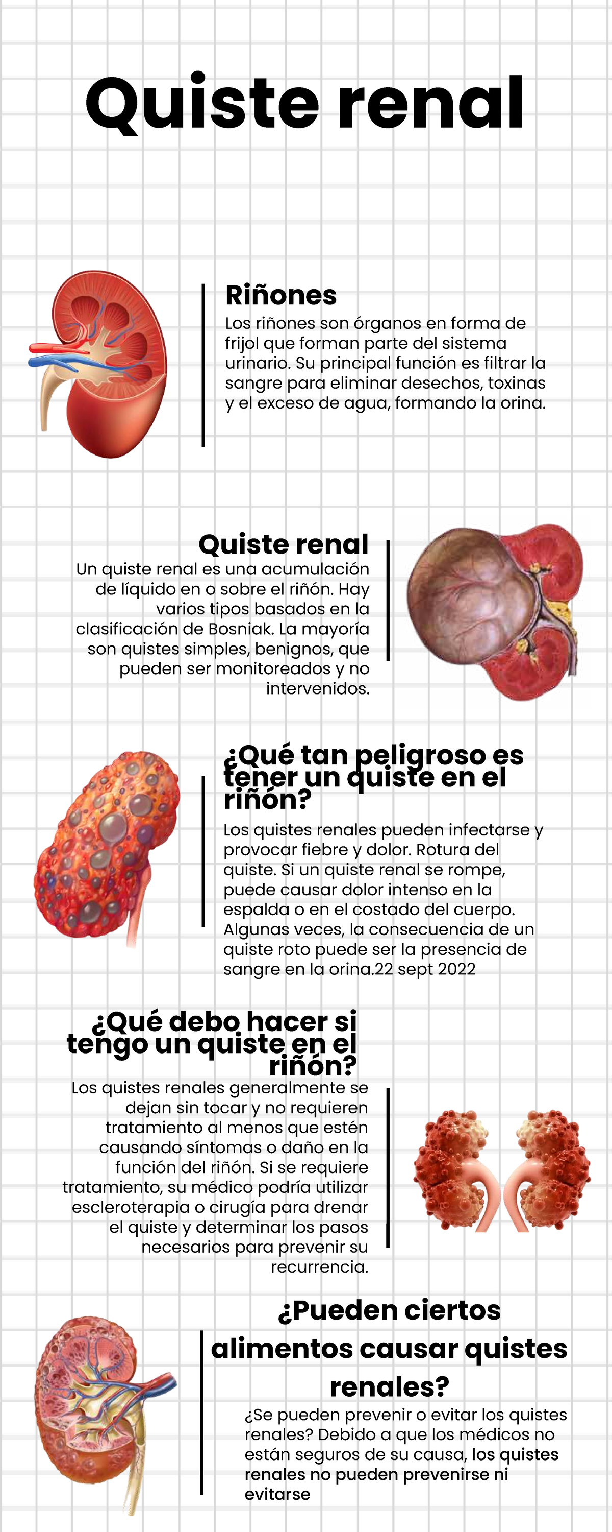 Infografía sobre Quistes Renales en el Sistema Urinario - Studocu