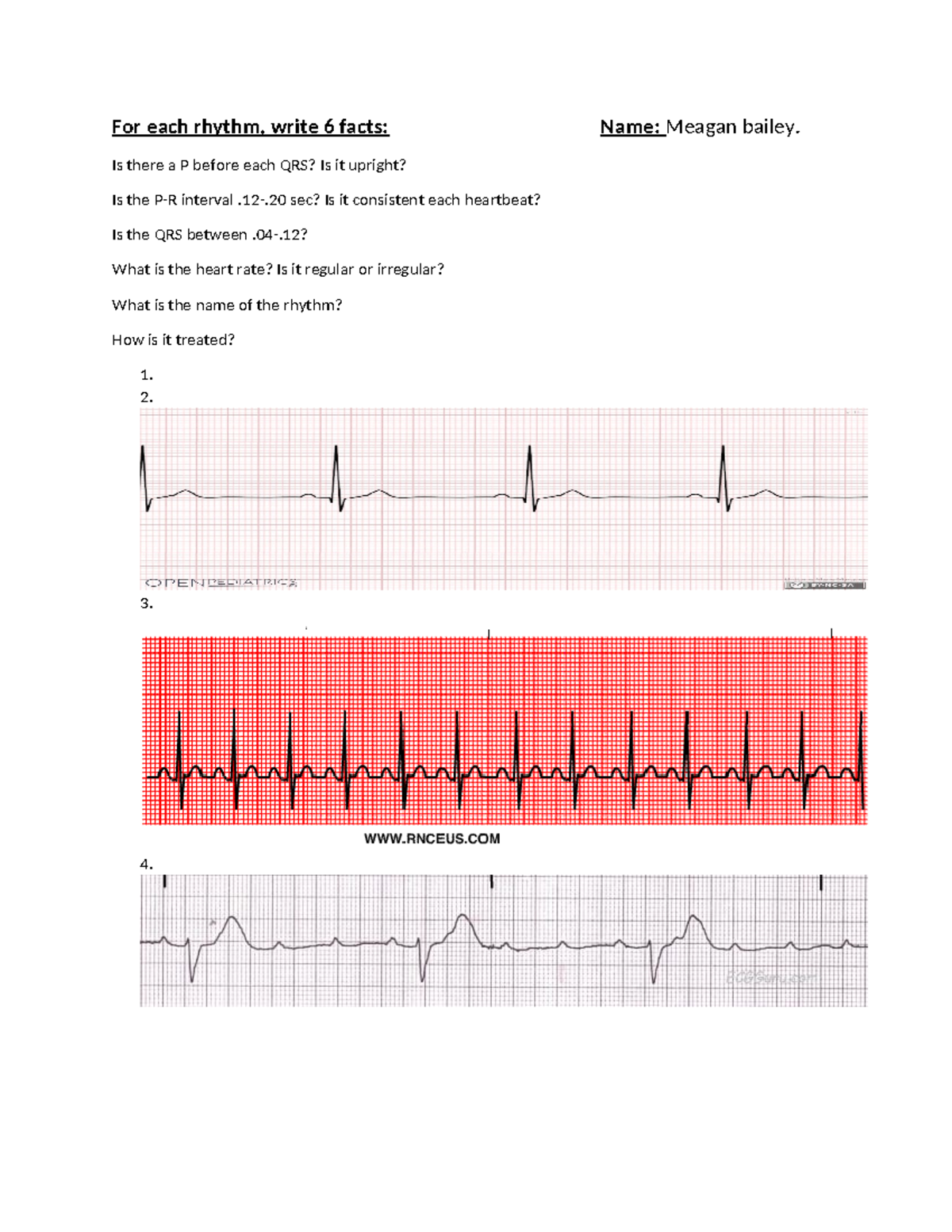 ECG Rhythm Identification Assignment (Aaa) - Studocu