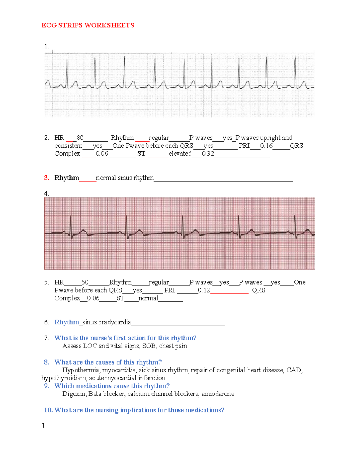 ECG Strips Practice for MedSurg Nursing: Key Dysrhythmias Insights ...