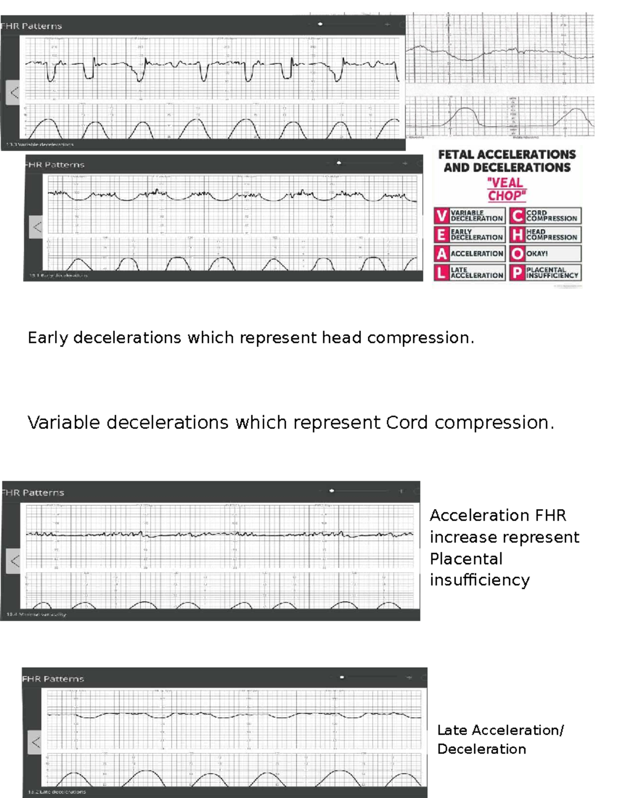 FHR Patterns and Implications: Early & Late Decelerations in Labor ...