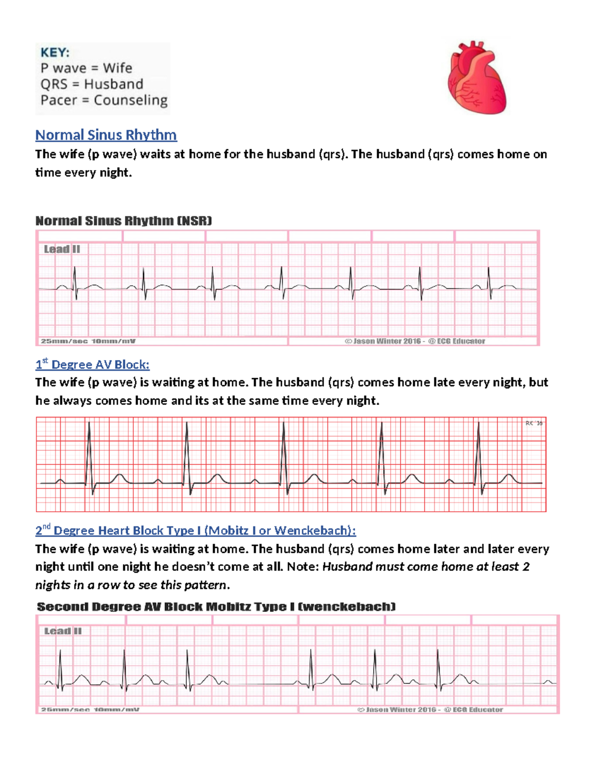 EKG Heart Block Poem Notes: Understanding AV Blocks in Rhythm - Studocu