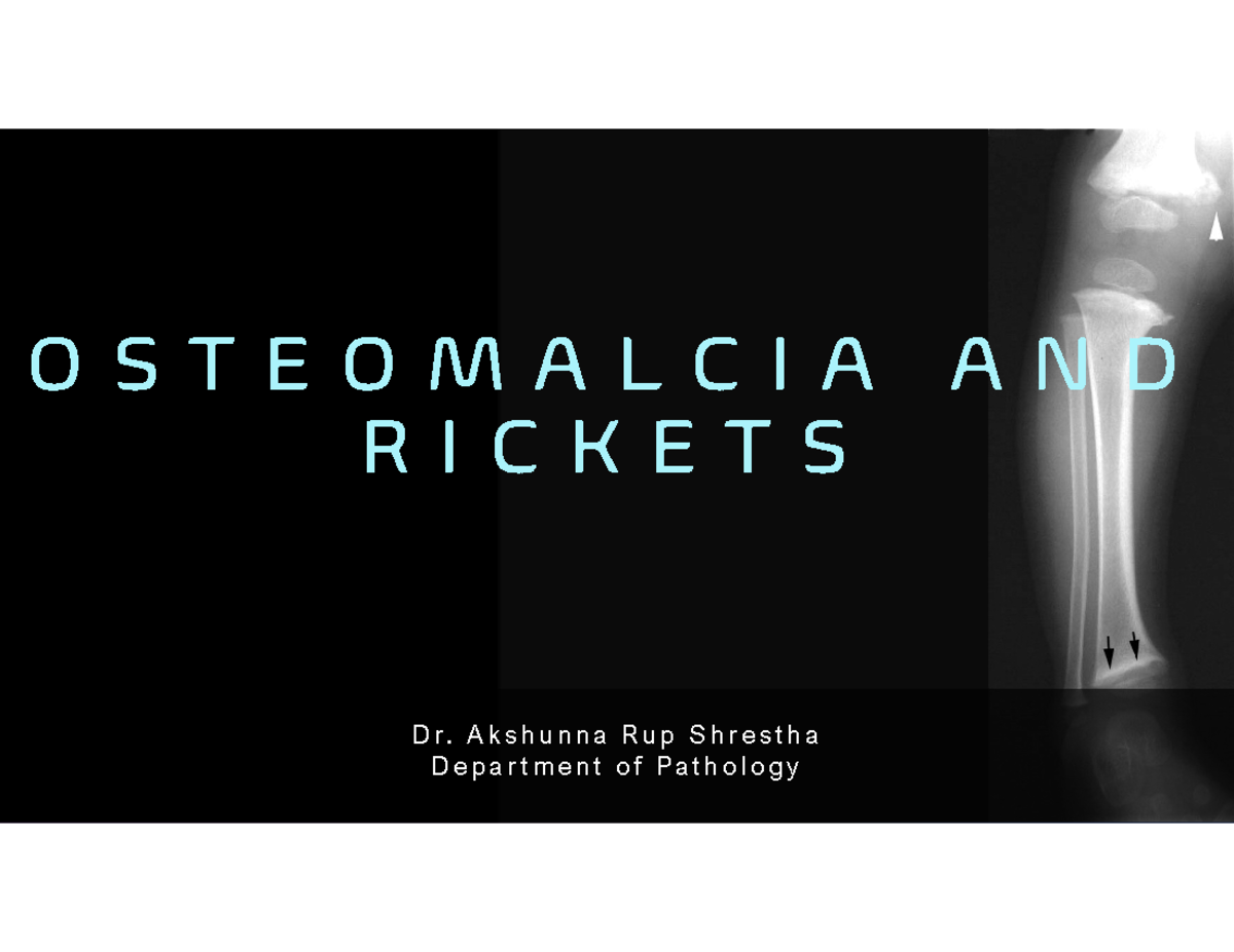 OSTEOMALACIA AND RICKETS: Pathology Insights and Clinical Features ...