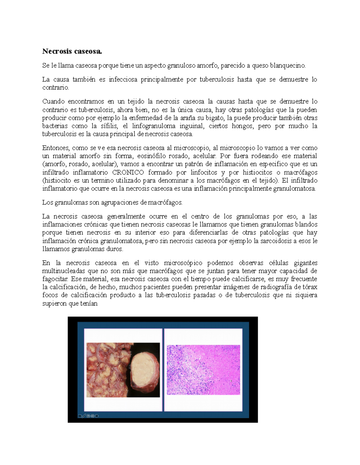 Estudio sobre Necrosis Caseosa en Laboratorio de Patología - Studocu