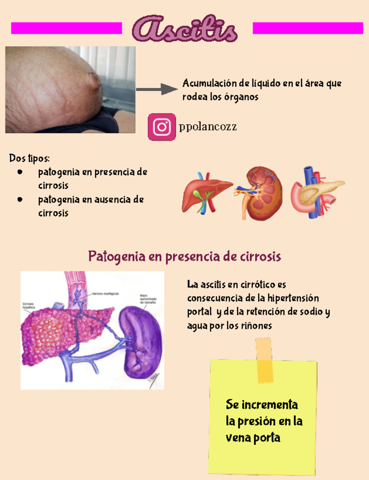 Ascitis Semiologia De Abdomen Acumulación De Líquido En El área Que