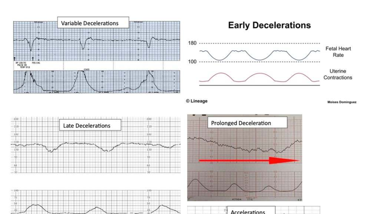 Variable Decelerations & Fetal Heart Rate Analysis - Moises Dominguez ...