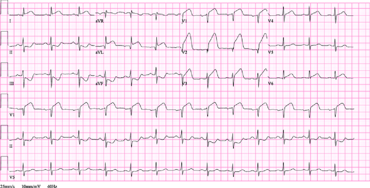 ECG Stemi ECG anterolateral Stemi - HNN227 - Studocu