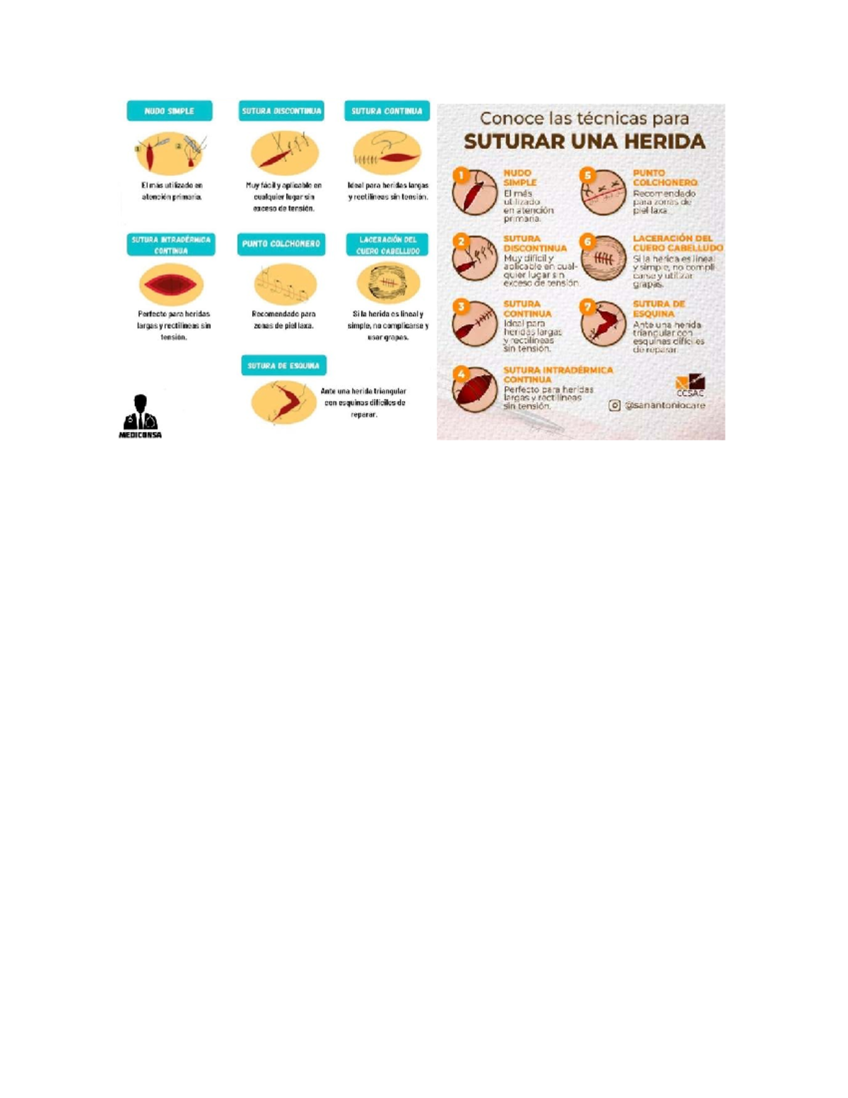 Técnicas de Sutura: Nudo Simple y Sutura Continua en Atención Primaria - Studocu