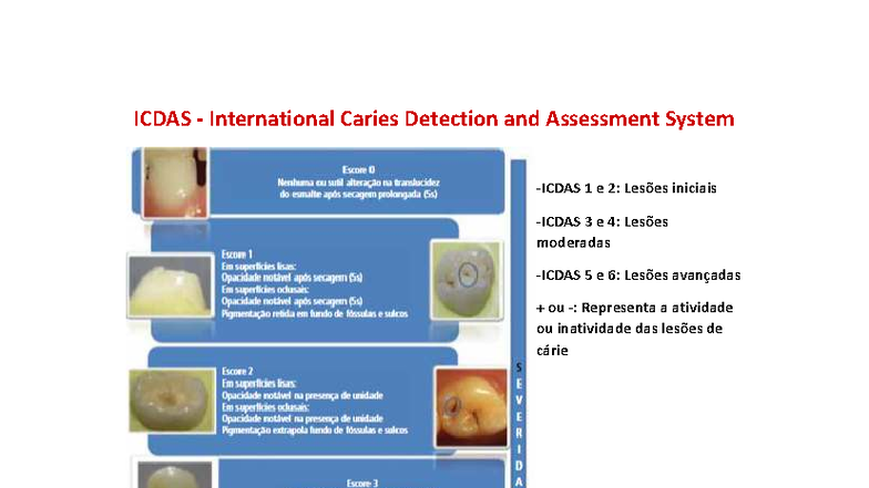 ICDAS: Sistema Internacional de Detecção e Avaliação de Cáries - Studocu