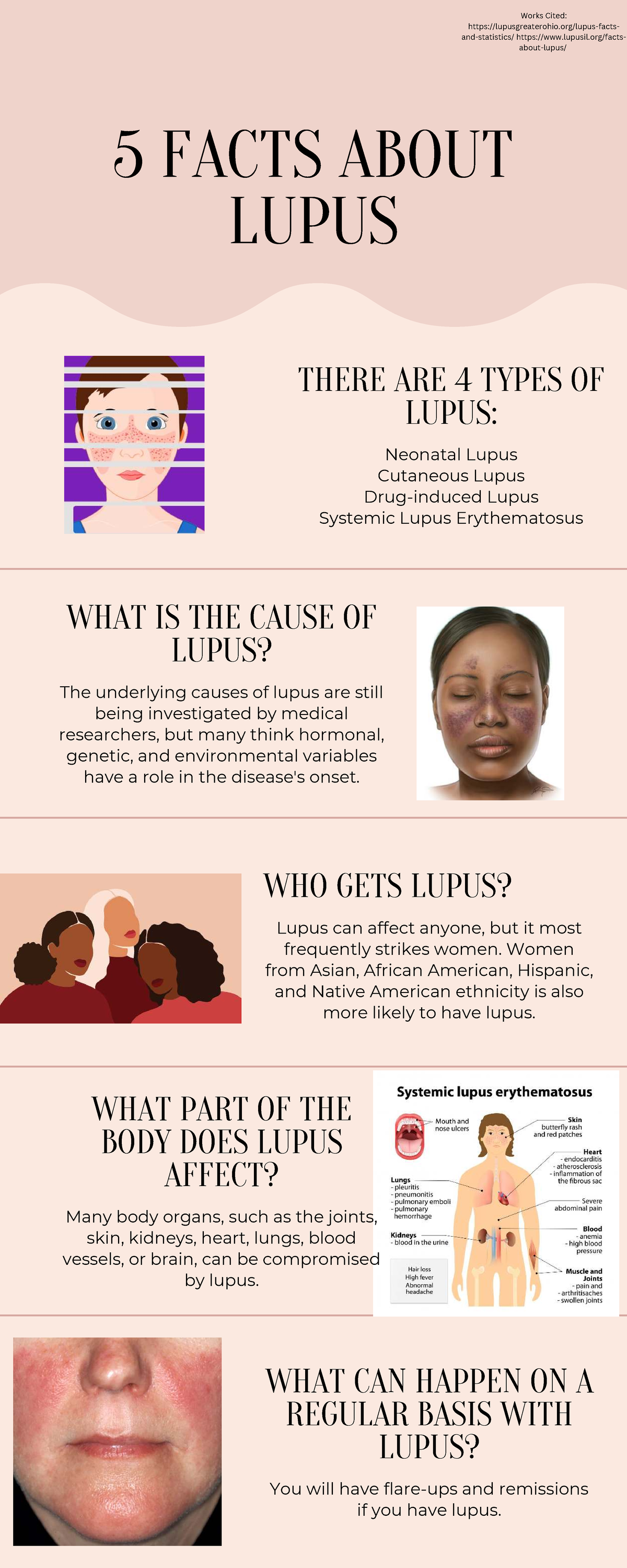 LUPUS 101: 5 Key Facts & Types of Lupus Explained - Studocu