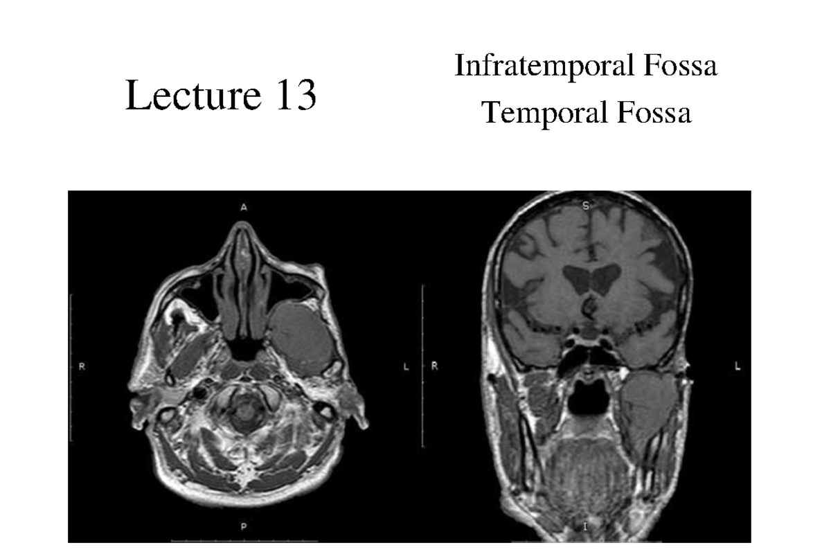 Cranial Nerves and Vascular Anatomy in the Infratemporal Fossa (MED 101 ...