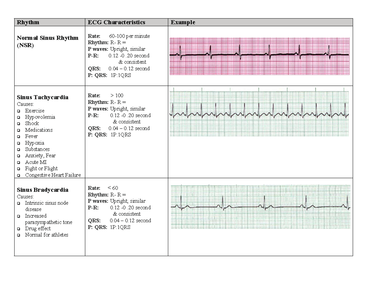 EKG Cheat Sheet: Rhythm ECG Characteristics and Analysis - Studocu