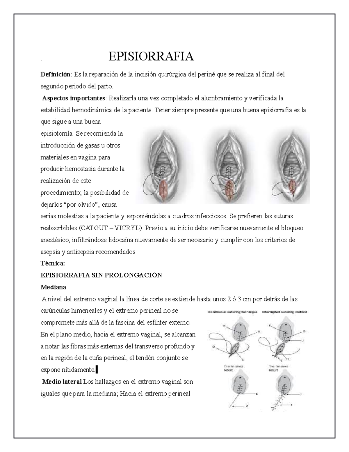 Episiorrafia tipos de epicio - . EPISIORRAFIA Definición : Es la ...