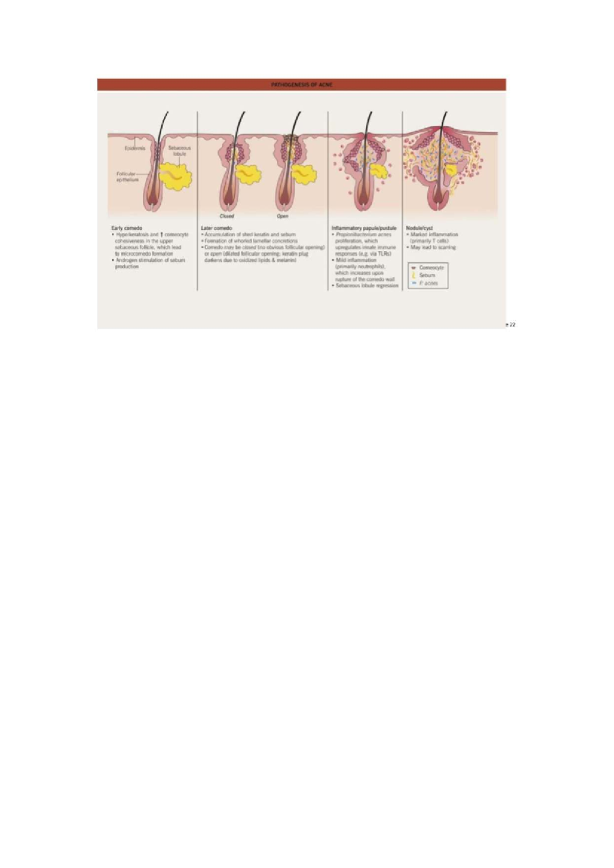 PATHOGENESIS OF ACNE: Insights into Follicular Dynamics and ...