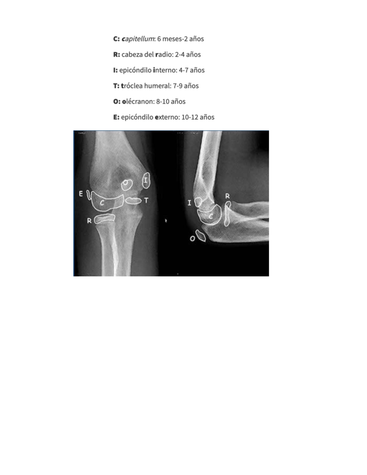 Critoe - Imagenologia y radiologia - C: capitellum: 6 años R: cabeza ...